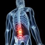 Lumbar Radiofrequency Ablation - Delaware Valley Pain & Spine ...