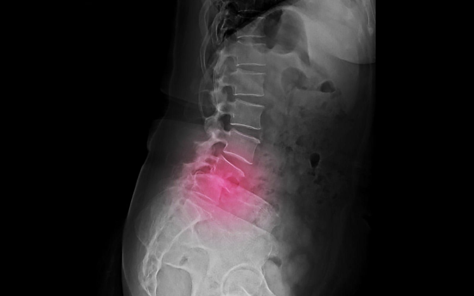 Discovering Lumbar Discectomies and How They Can Help You - Delaware ...