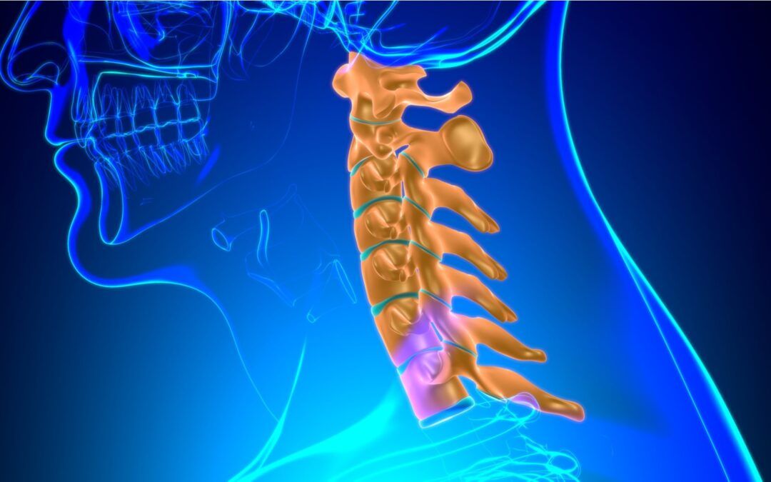 What Is Cervical Artificial Disc Replacement? - Delaware Valley Pain ...